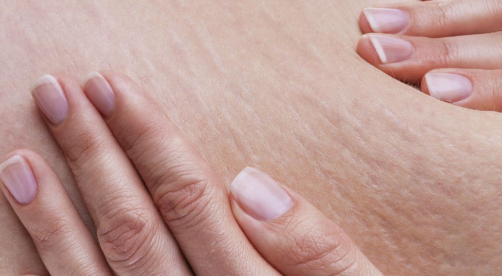 How To Prevent Stretch Marks By Rejuvenating Your Collagen ...